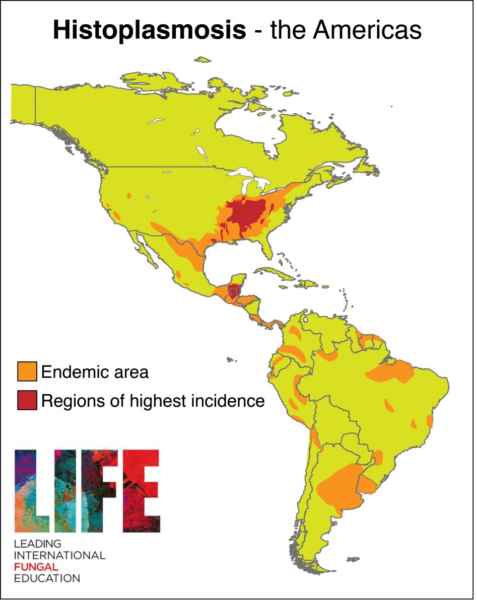 Disseminated histoplasmosis - Life Worldwide