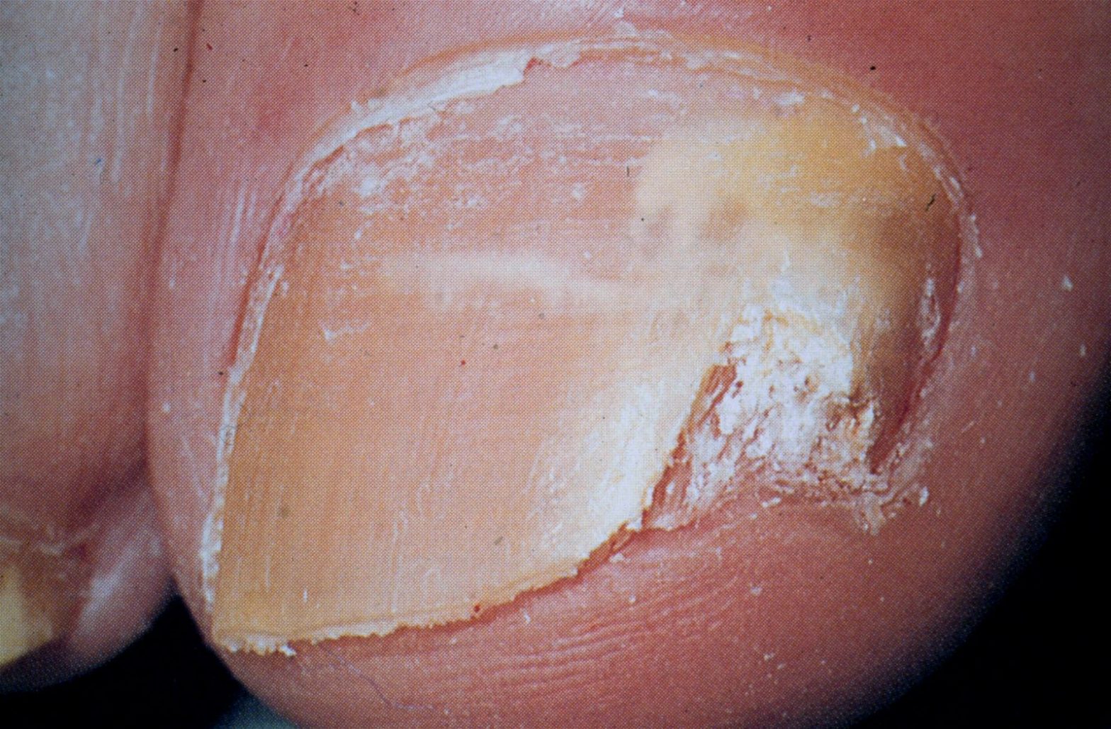 Onychomycosis - Life Worldwide