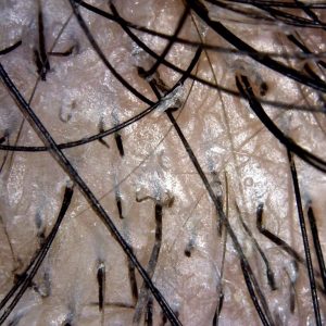 Dermoscopy - Life Worldwide