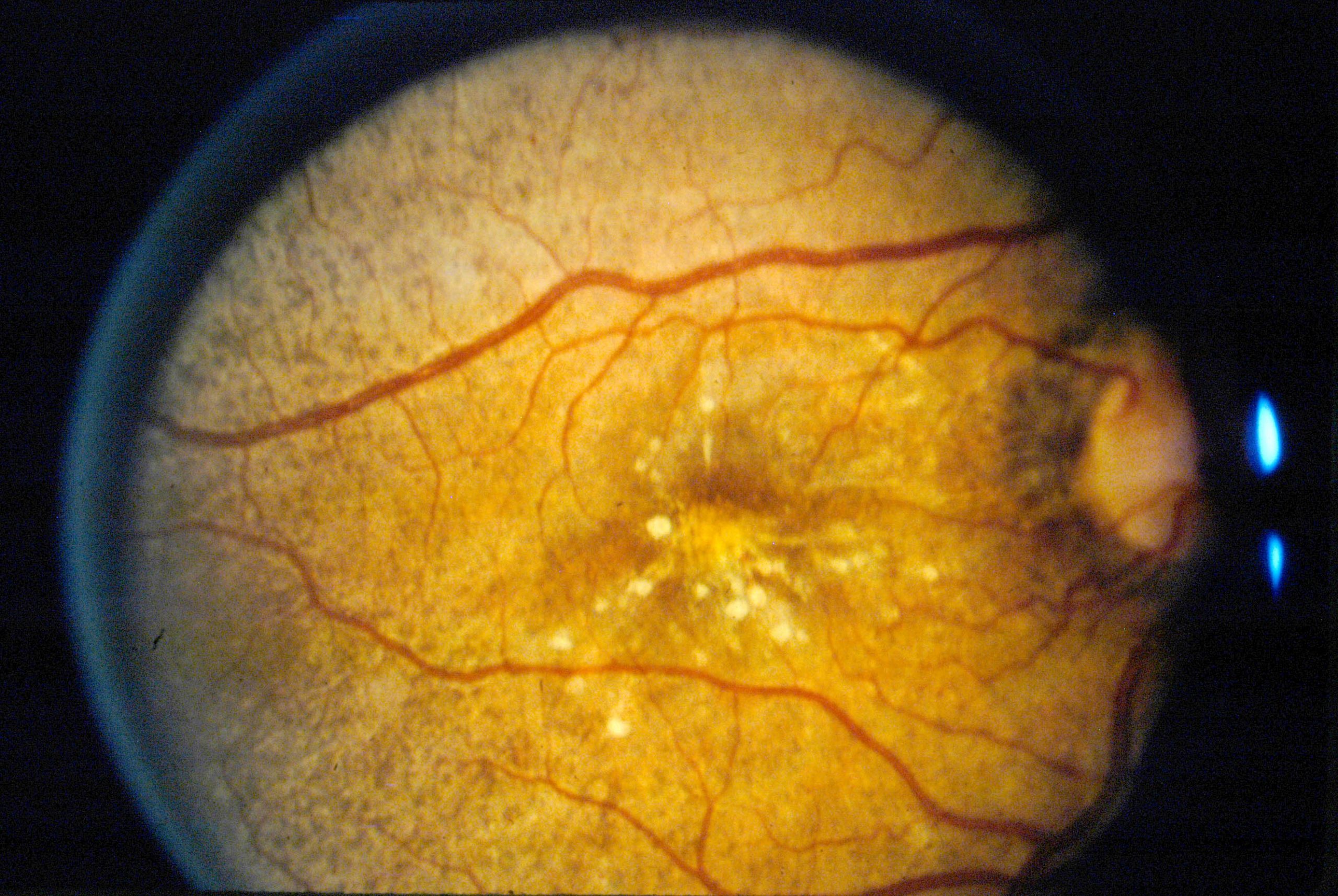 Fungal eye infections - Life Worldwide