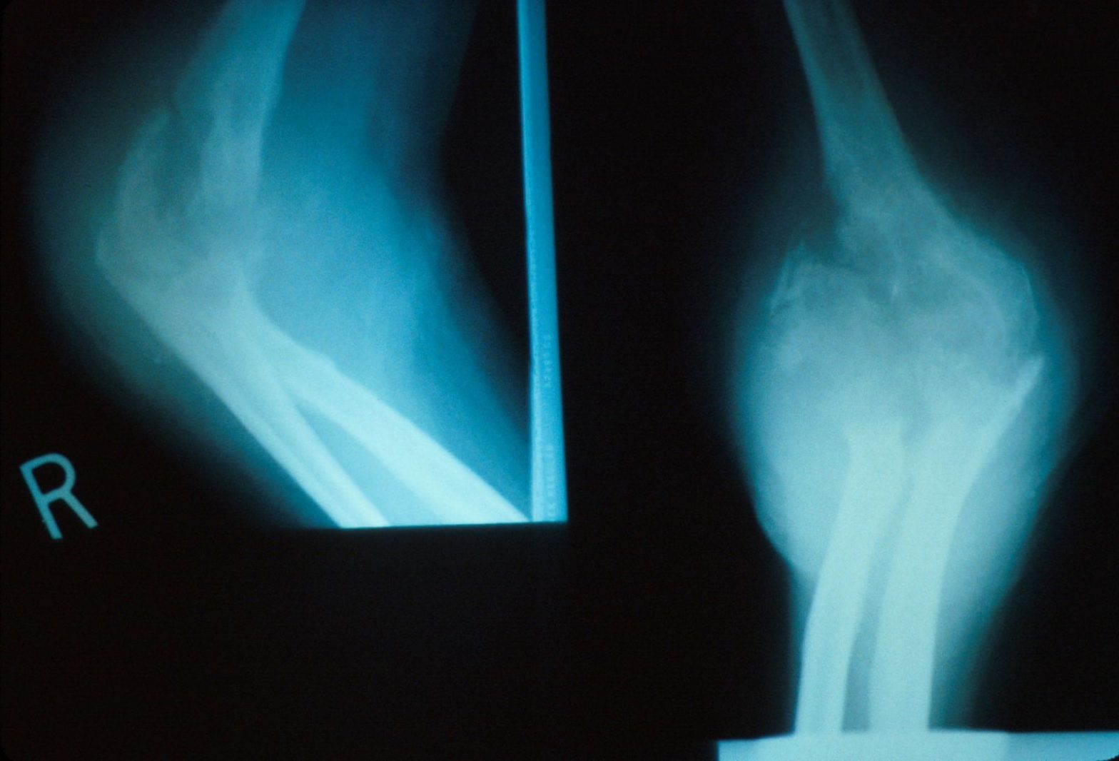 Endemic mycoses - Life Worldwide