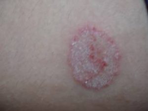 Tinea - Life Worldwide