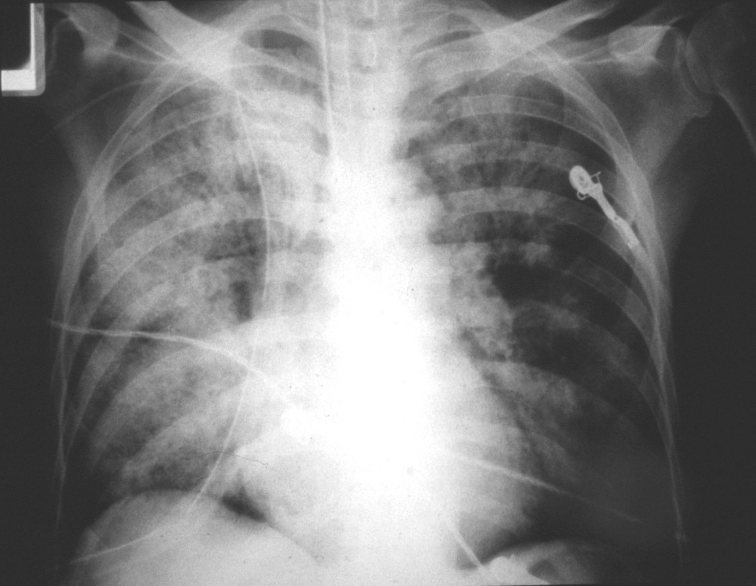 Pneumocystis pneumonia - Life Worldwide
