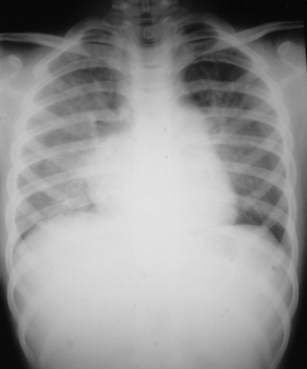 Pneumocystis pneumonia - Life Worldwide