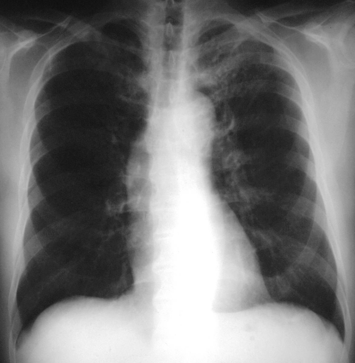 Pneumocystis pneumonia - Life Worldwide