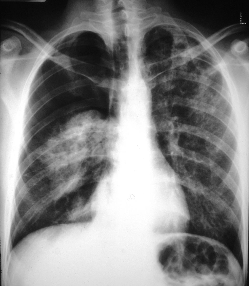 Pneumocystis pneumonia - Life Worldwide