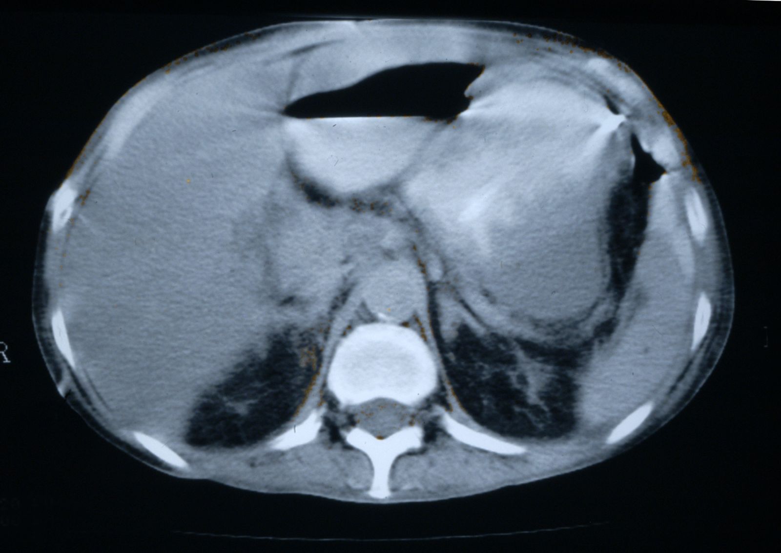 Invasive Candida - Life Worldwide