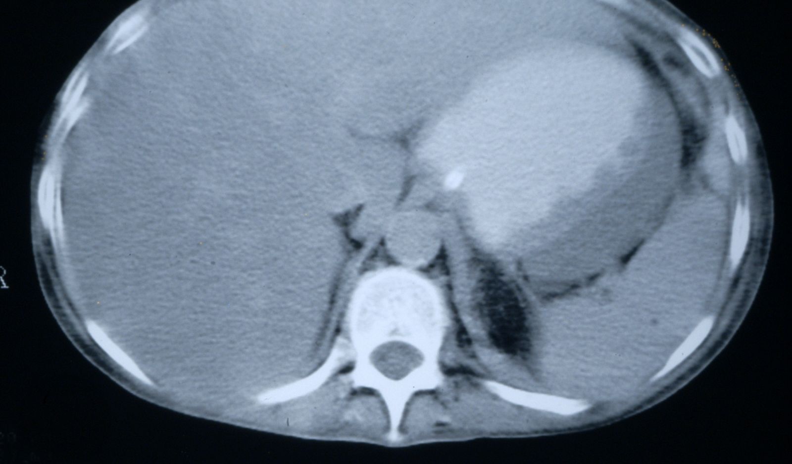 Invasive Candida - Life Worldwide