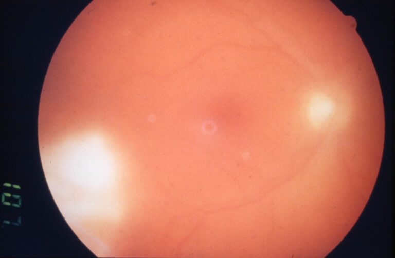 Talaromycosis - Life Worldwide