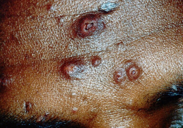 Talaromycosis - Life Worldwide