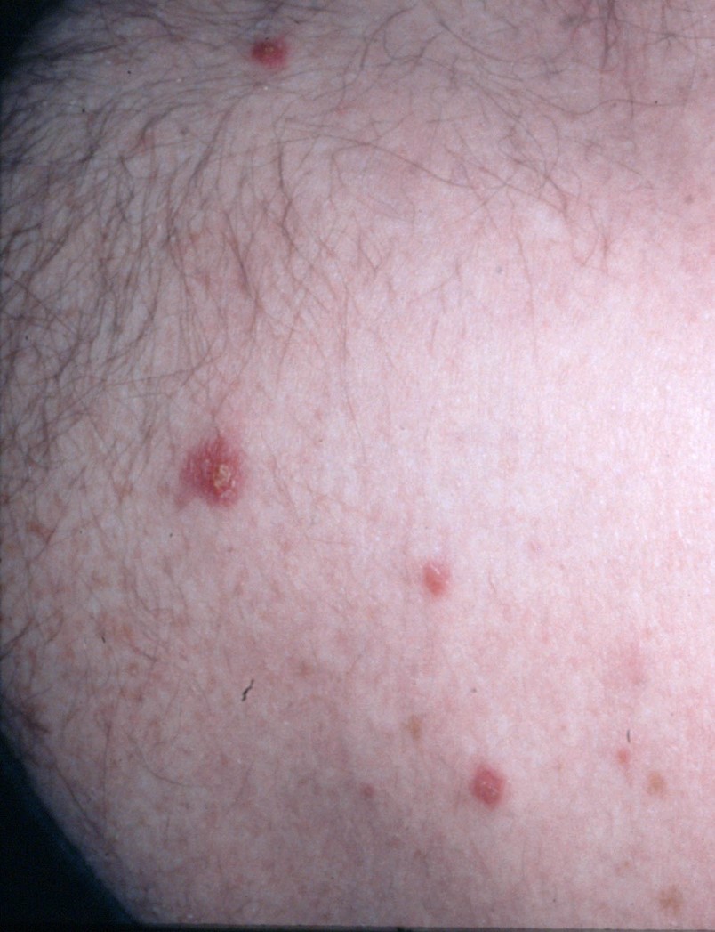 Talaromycosis - Life Worldwide